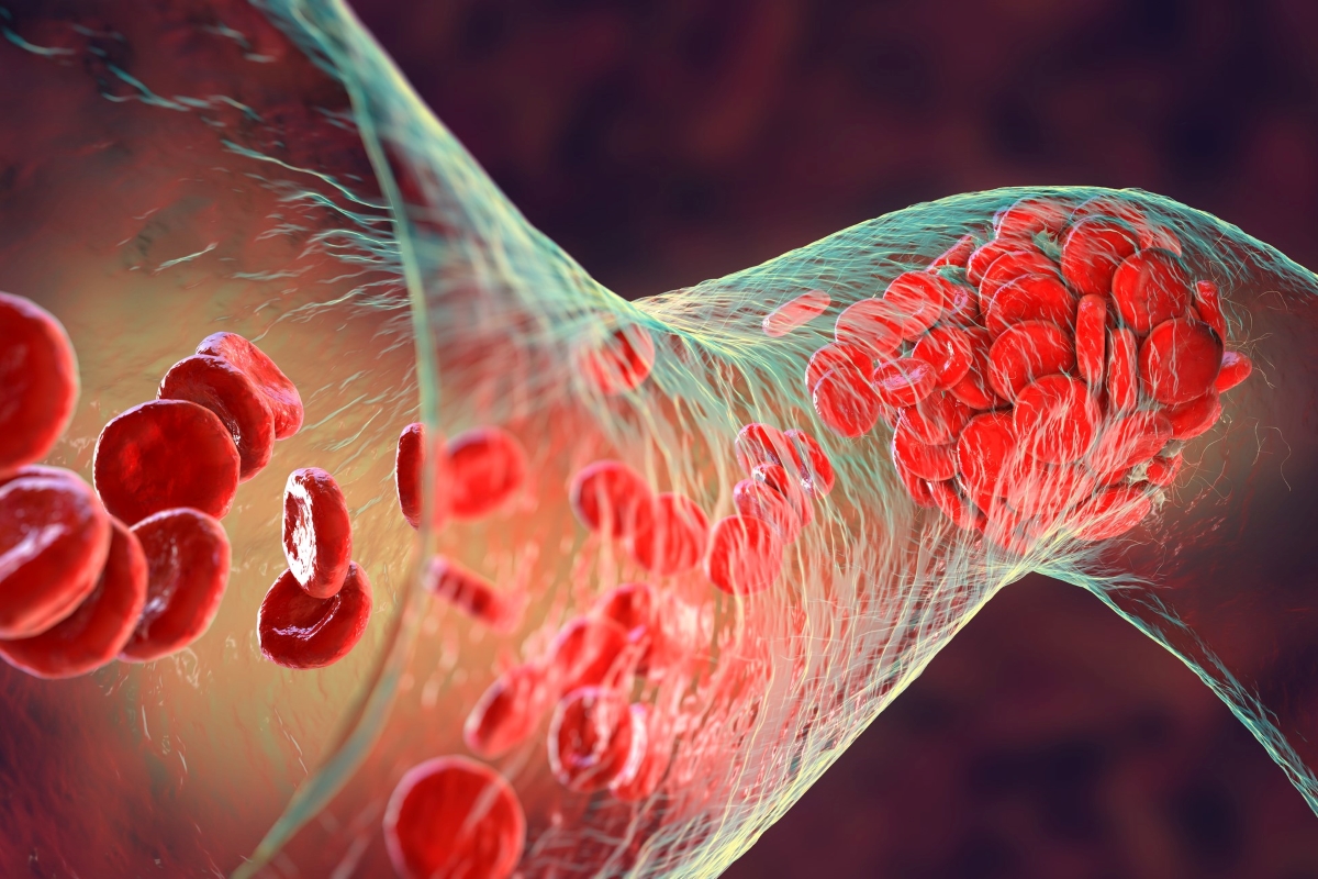 Deep vein thrombosis 101: Everything you should know | Northside Hospital